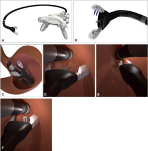 Gastro-esophageal reflux disease (GERD) - Mission Gastro Hospital