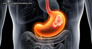 Early Warning Signs Of Stomach Cancer - Mission Gastro Hospital